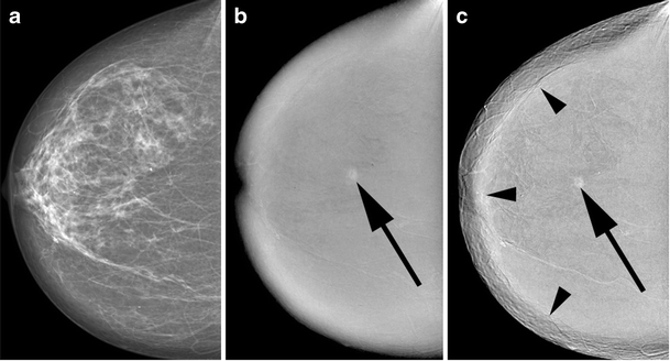 Contrast-enhanced dual energy mammography with a novel anode/filter ...