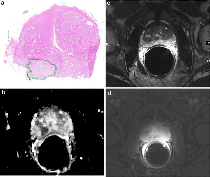 Updated prostate imaging reporting and data system (PIRADS v2 ...
