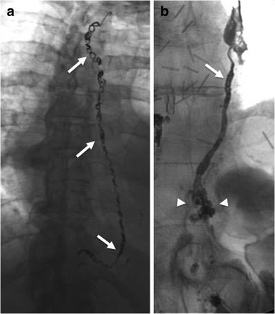 The thoracic duct: clinical importance, anatomic variation, imaging ...