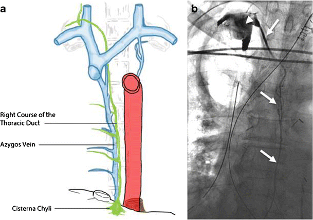 The thoracic duct: clinical importance, anatomic variation, imaging ...