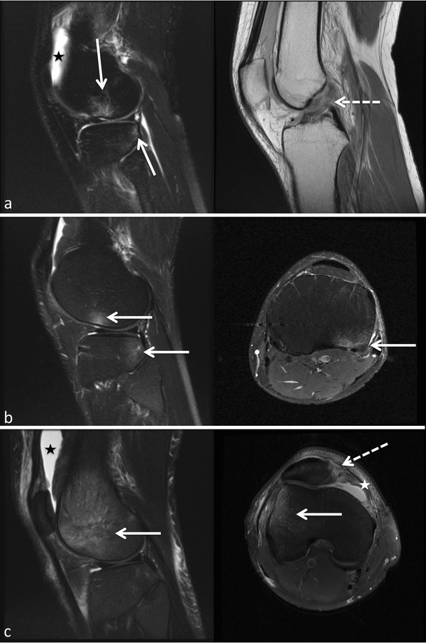 Association between traumatic bone marrow abnormalities of the knee ...