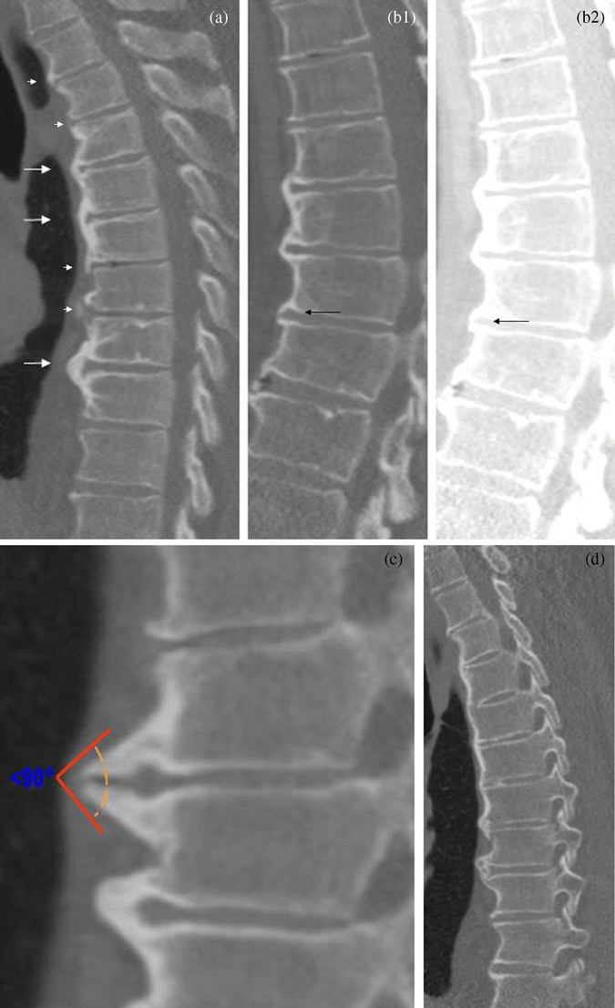 Diagnosis of diffuse idiopathic skeletal hyperostosis with chest ...