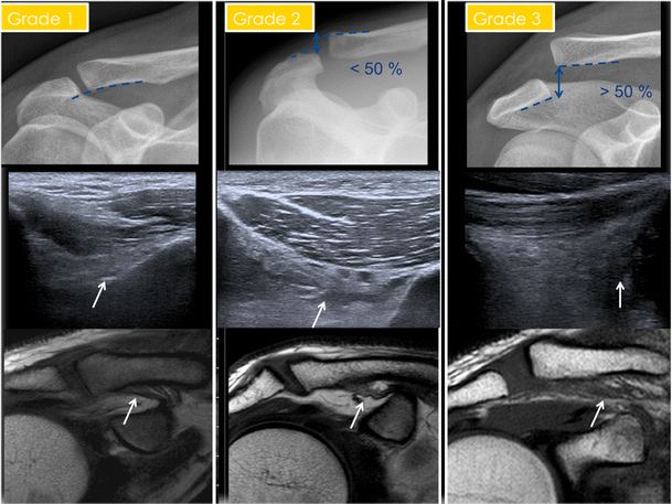 Ultrasound of the coracoclavicular ligaments in the acute phase of an ...