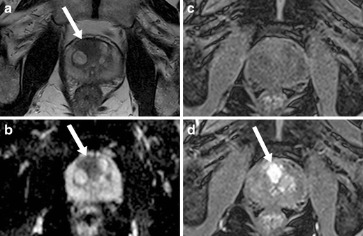 “Textural analysis of multiparametric MRI detects transition zone ...