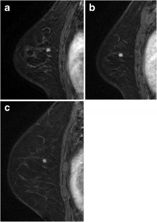 Management for BI-RADS category 3 lesions detected in preoperative ...