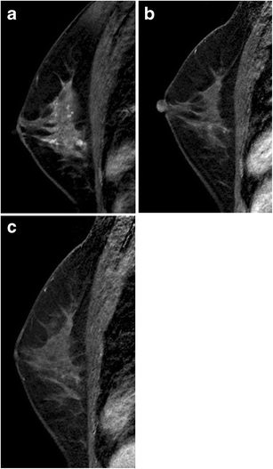 Management for BI-RADS category 3 lesions detected in preoperative breast MR imaging of breast ...