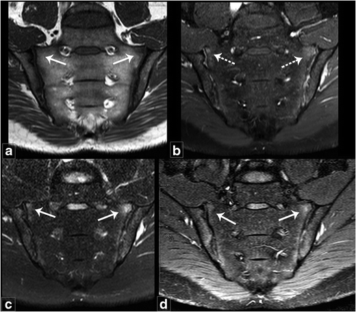 MRI assessment of bone marrow oedema in the sacroiliac joints of ...