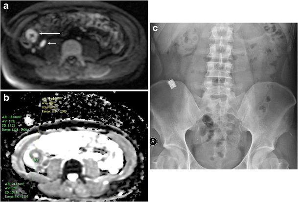 Assessment of patency capsule retention using MR diffusion-weighted ...