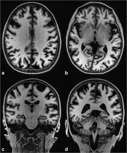 Evaluating anorexia-related brain atrophy using MP2RAGE-based ...