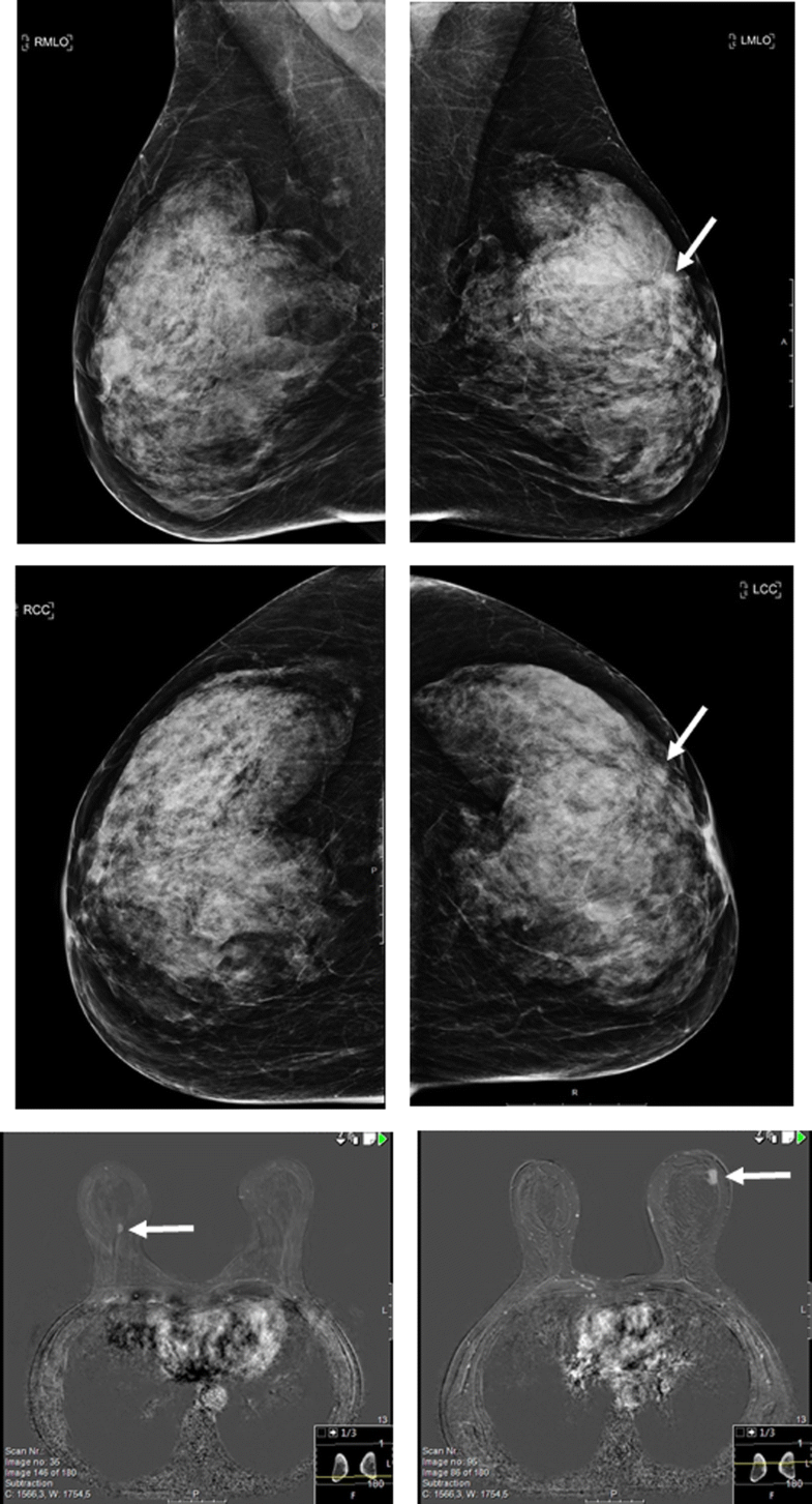 Frequency and characteristics of contralateral breast abnormalities ...