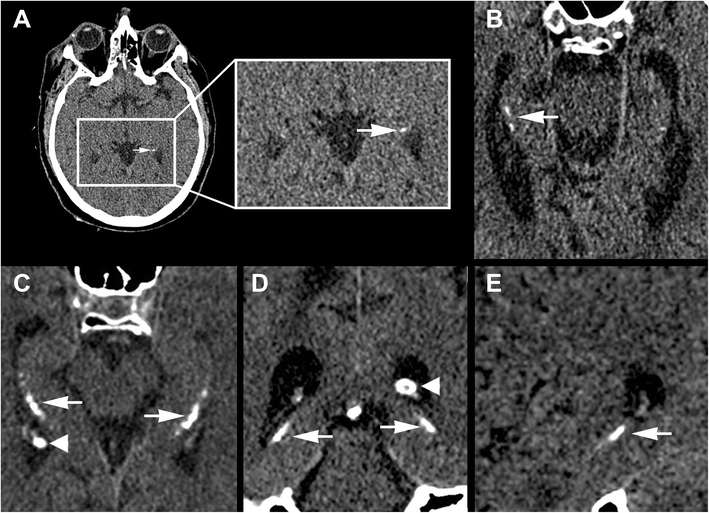 Hippocampal calcification on brain CT: prevalence and risk factors in a ...