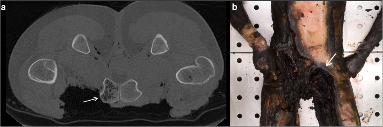 The value of post-mortem computed tomography of burned victims in a ...