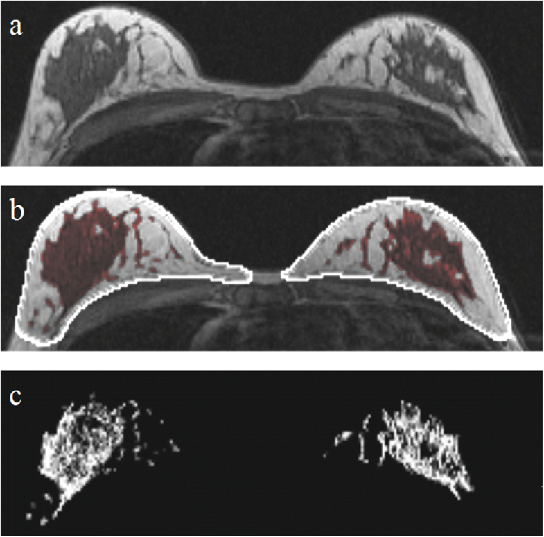 Amount of fibroglandular tissue FGT and background parenchymal ...