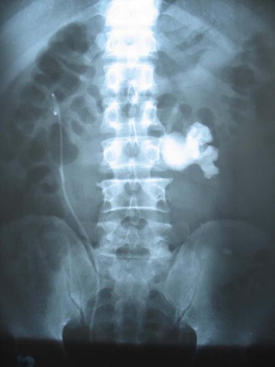 Robotic extended pyelolithotomy for treatment of renal calculi: a ...