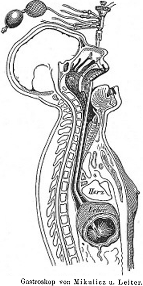 Johann Anton von Mikulicz-Radecki (1850–1905)—a pioneer of gastroscopy ...