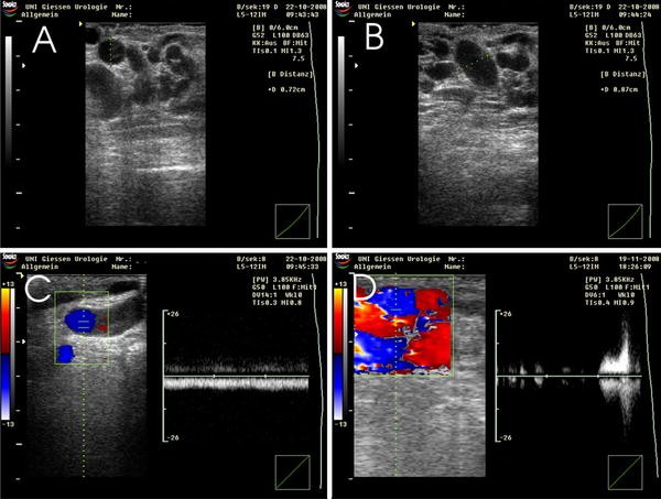 Color Doppler ultrasound imaging in varicoceles: is the venous diameter ...