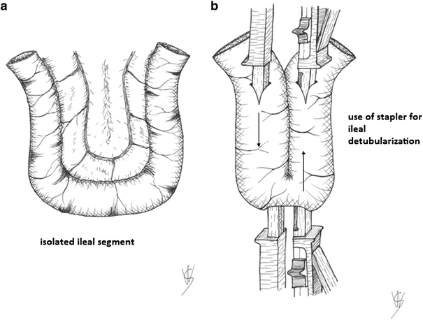 Perugia ileal neobladder: functional results and complications ...