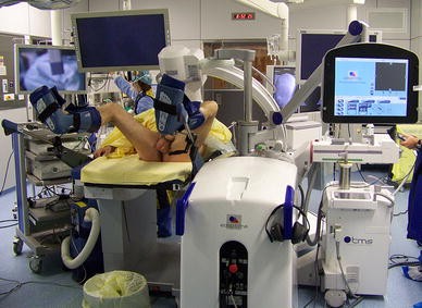 Extracorporeal lithotripsy endoscopically controlled by ...