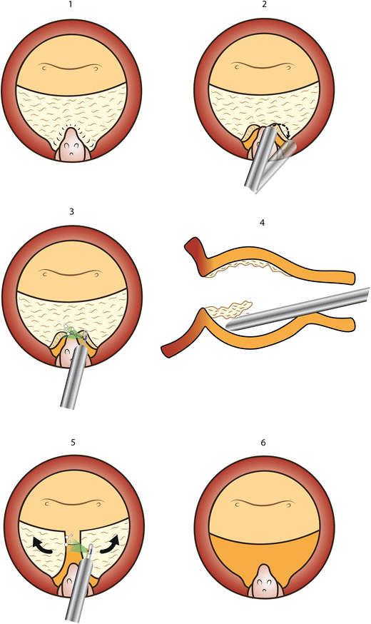 Common trend: move to enucleation—Is there a case for GreenLight ...
