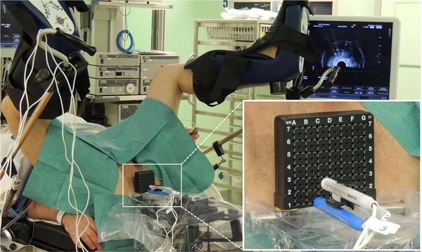 The correlation between the electrode configuration and histopathology ...