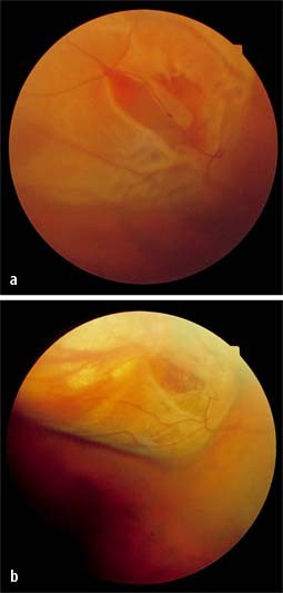 Skleraeindellende Ablatiochirurgie und pneumatische Retinopexie ...