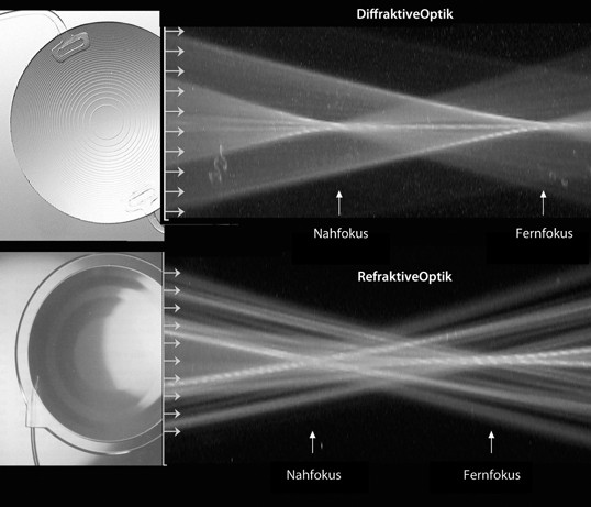 Design und optische Prinzipien von Multifokallinsen | SpringerLink