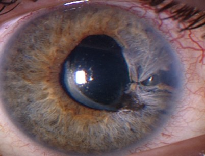 Ursache einer Contusio bulbi | SpringerLink