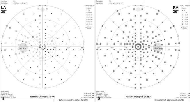 Ein topodiagnostisch wegweisender Gesichtsfeldausfall | SpringerLink