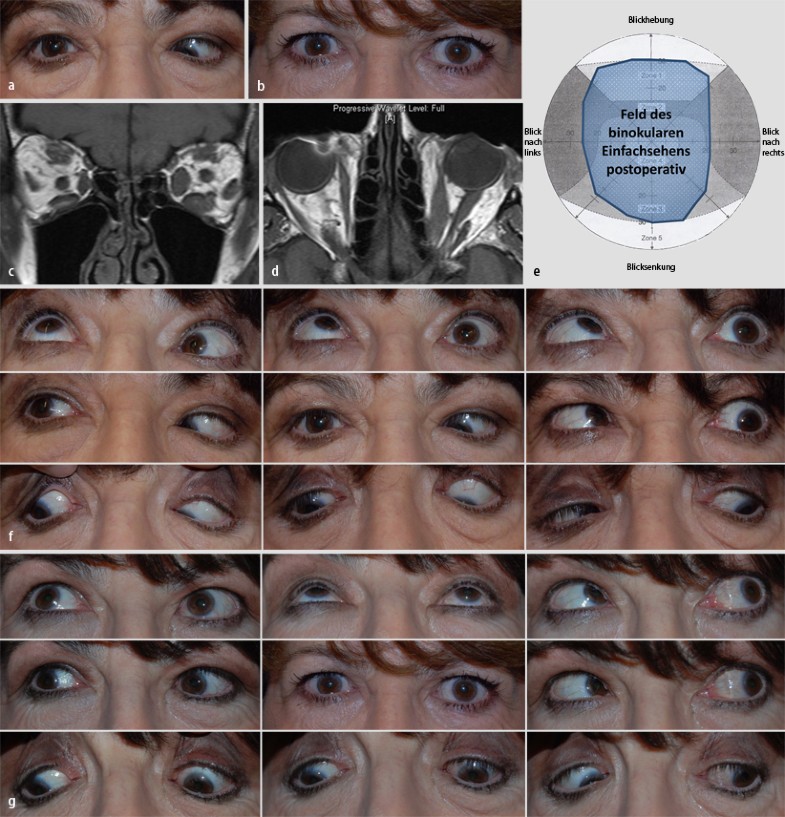 Update endokrine Orbitopathie | SpringerLink