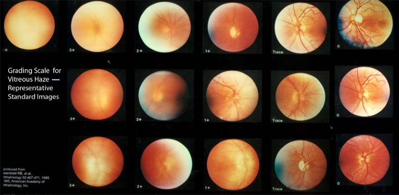 Uveitis intermedia | SpringerLink