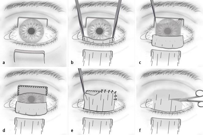 Ergebnisse nach Cutler-Beard-Plastik zur Rekonstruktion ausgedehnter ...