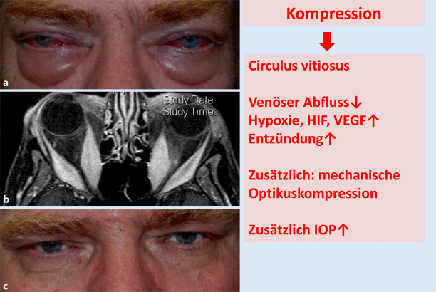 Endokrine Orbitopathie | SpringerLink
