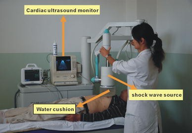 Randomized and double-blind controlled clinical trial of extracorporeal ...