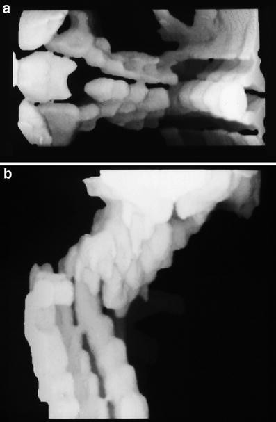 Segmental spinal dysgenesis: report of four cases and proposed ...