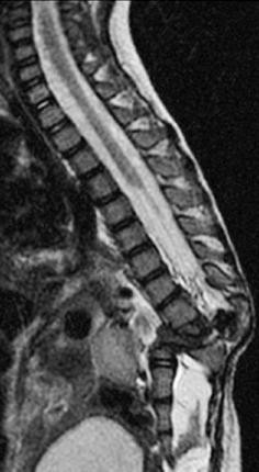 Segmental spinal dysgenesis: report of four cases and proposed ...