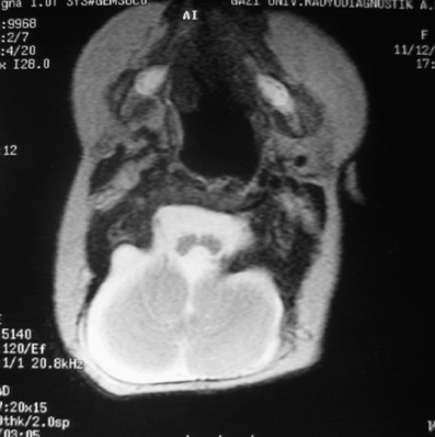 Iniencephaly and long-term survival: a rare case report | SpringerLink
