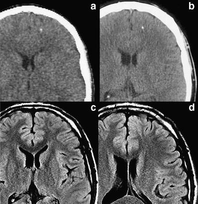 Focal cortical dysplasia with calcification: a case report | SpringerLink
