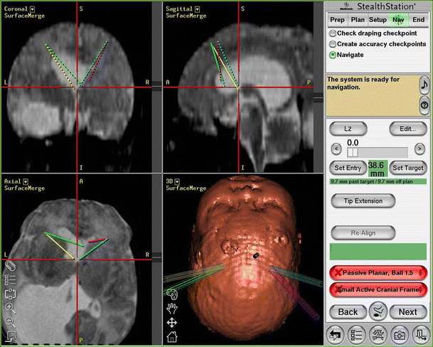 Neuroendoscopic foraminal plasty of foramen of Monro | SpringerLink