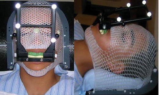 Initial clinical experience with frameless optically guided stereotactic radiosurgery ...