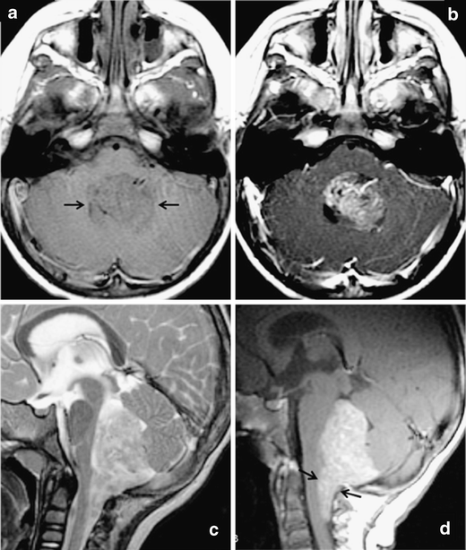 Imaging of ependymomas: MRI and CT | SpringerLink