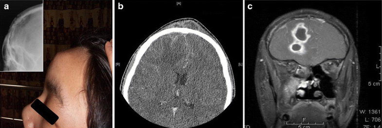 Pott’s puffy tumor in children | SpringerLink