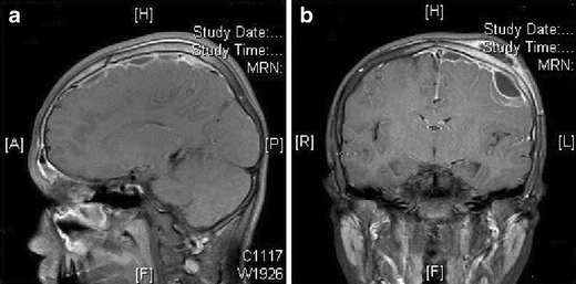 Pott’s puffy tumor in children | SpringerLink