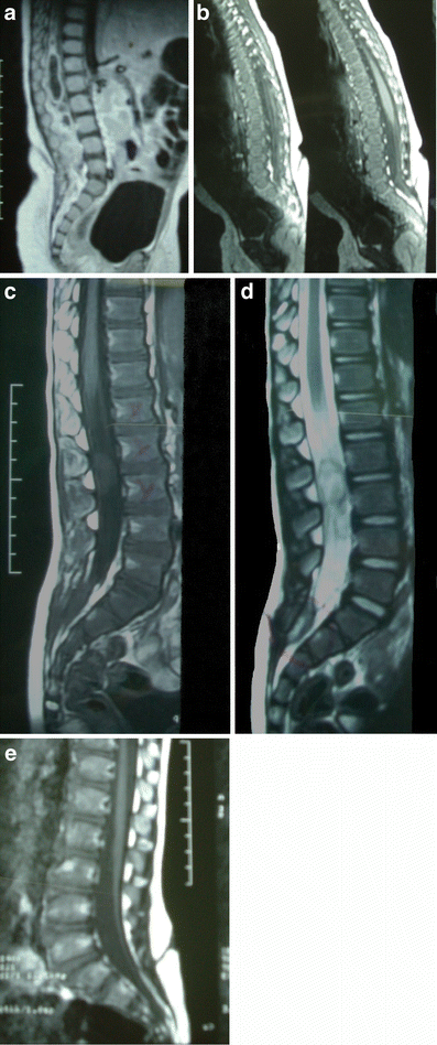 Dermal sinus tract of the spine | SpringerLink