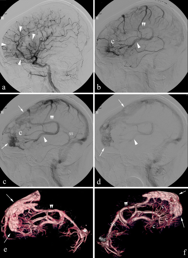 Cerebral developmental venous anomalies | SpringerLink