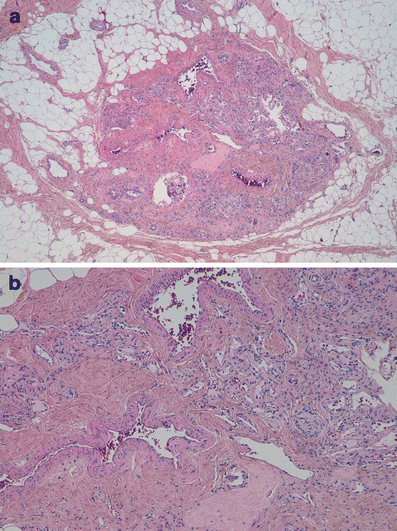 Spinal dermal sinus and pseudo-dermal sinus tracts: two different ...