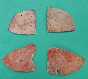 Split calvarial bone grafting in patients less than 1 year of age ...