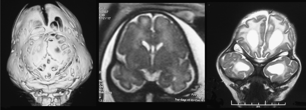 Cloverleaf skull deformity and hydrocephalus | SpringerLink