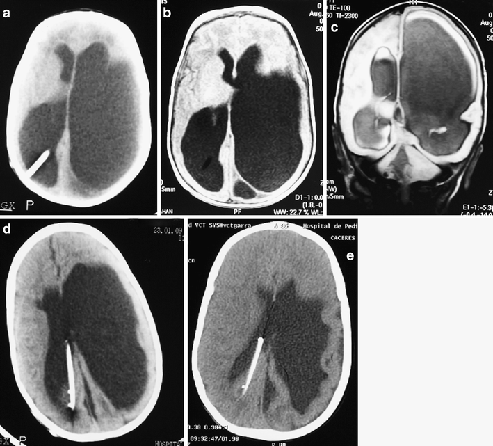 Multiloculated hydrocephalus | SpringerLink