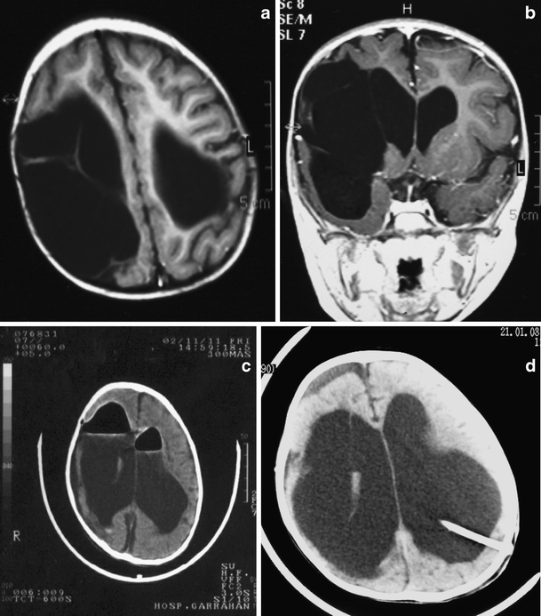 Multiloculated hydrocephalus | SpringerLink