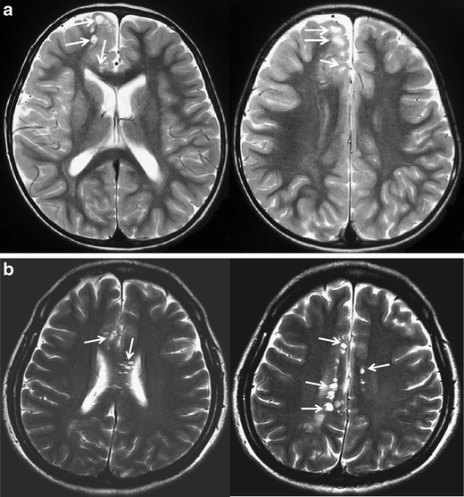The Virchow-Robin spaces: delineation by magnetic resonance imaging ...